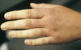 Prise en charge du syndrome de Raynaud - Rhumatos