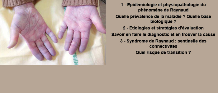 Le point sur le syndrome de Raynaud - Rhumatos