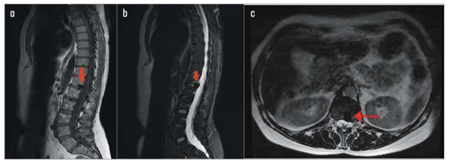 Résorption de calcification rachidienne : une pathologie rare aux ...
