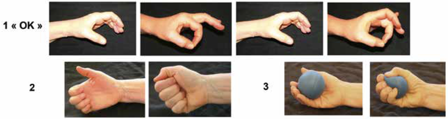 JFR 2024 - Traitement de l’arthrose digitale - Quelles recommandations ...
